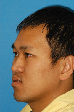 Jaw Surgery Photo Gallery - North Coast Jaw & Implant Center